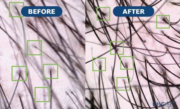 Cell Plus Stem Cell Therapy at Bangkok Hair Clinic