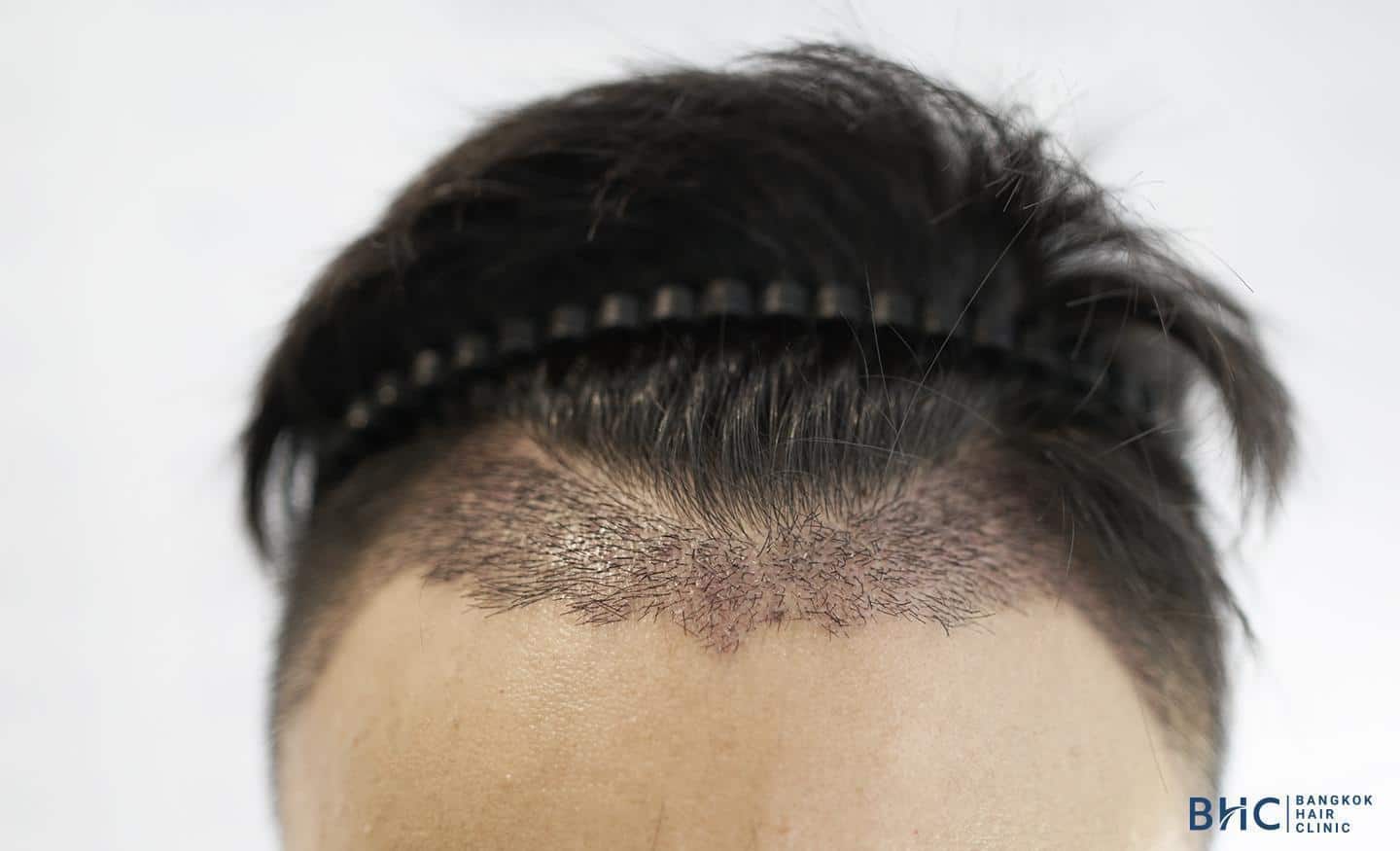 6 Important short-term complications after a hair transplant - Bangkok ...