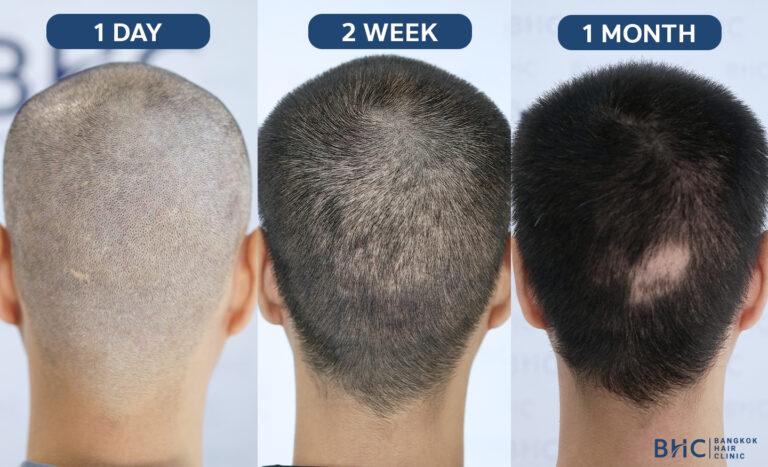 What is Shock Loss? Will it happen to me? - Bangkok Hair Clinic