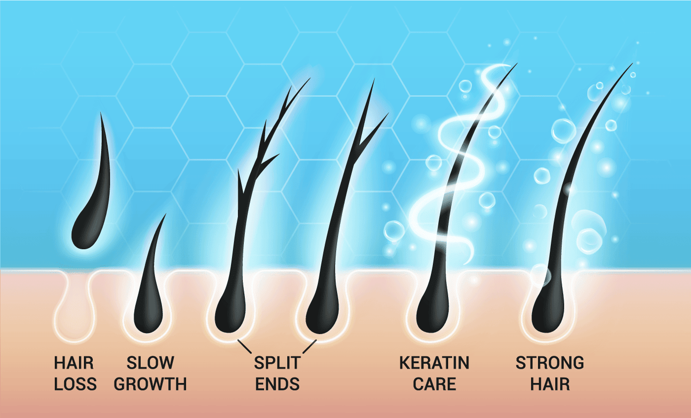 What is LLLT? | Is It a Possible Treatment for Hair Loss? - Bangkok ...
