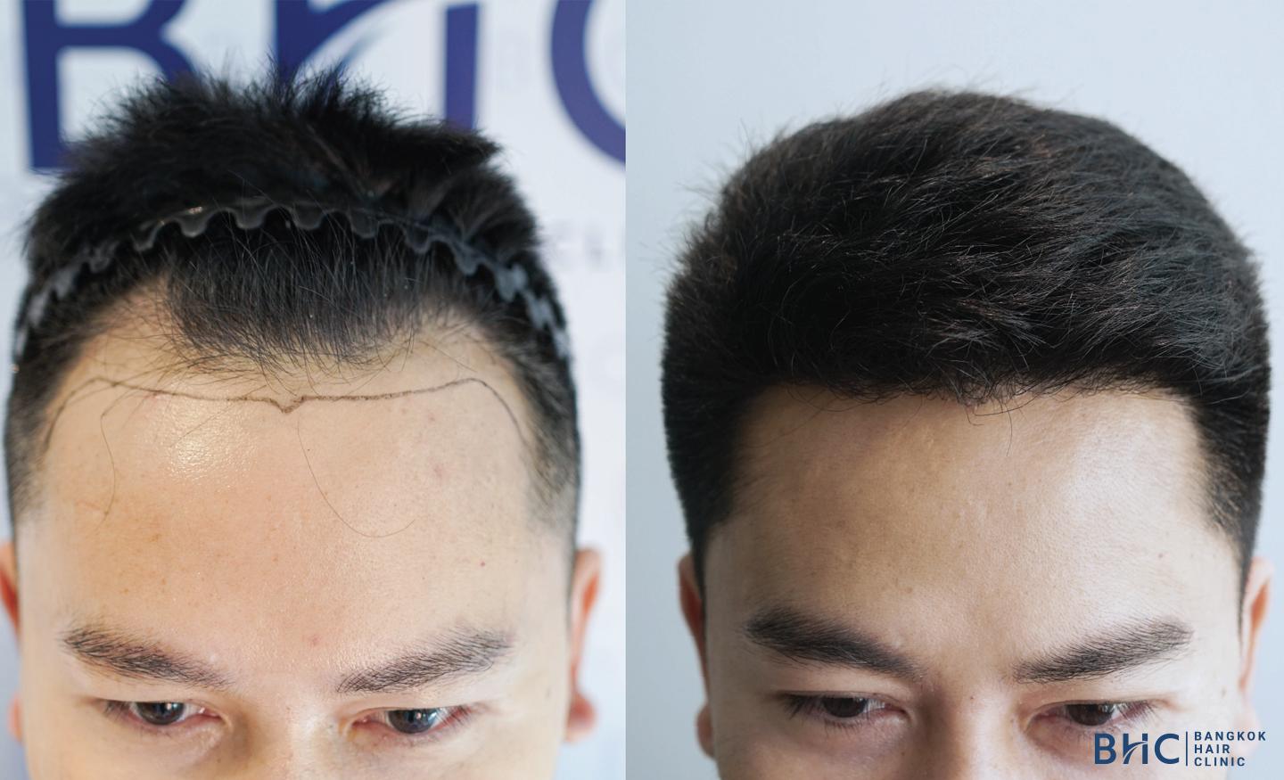 DHI (FUE with Implanter) - Bangkok Hair Clinic