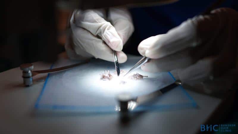 What is Micrograft? - Bangkok Hair Clinic