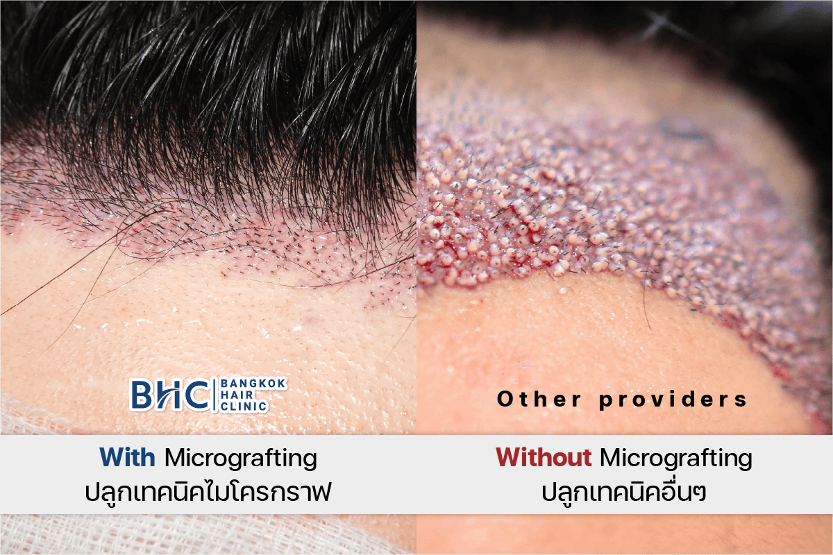 What is Micrograft? - Bangkok Hair Clinic
