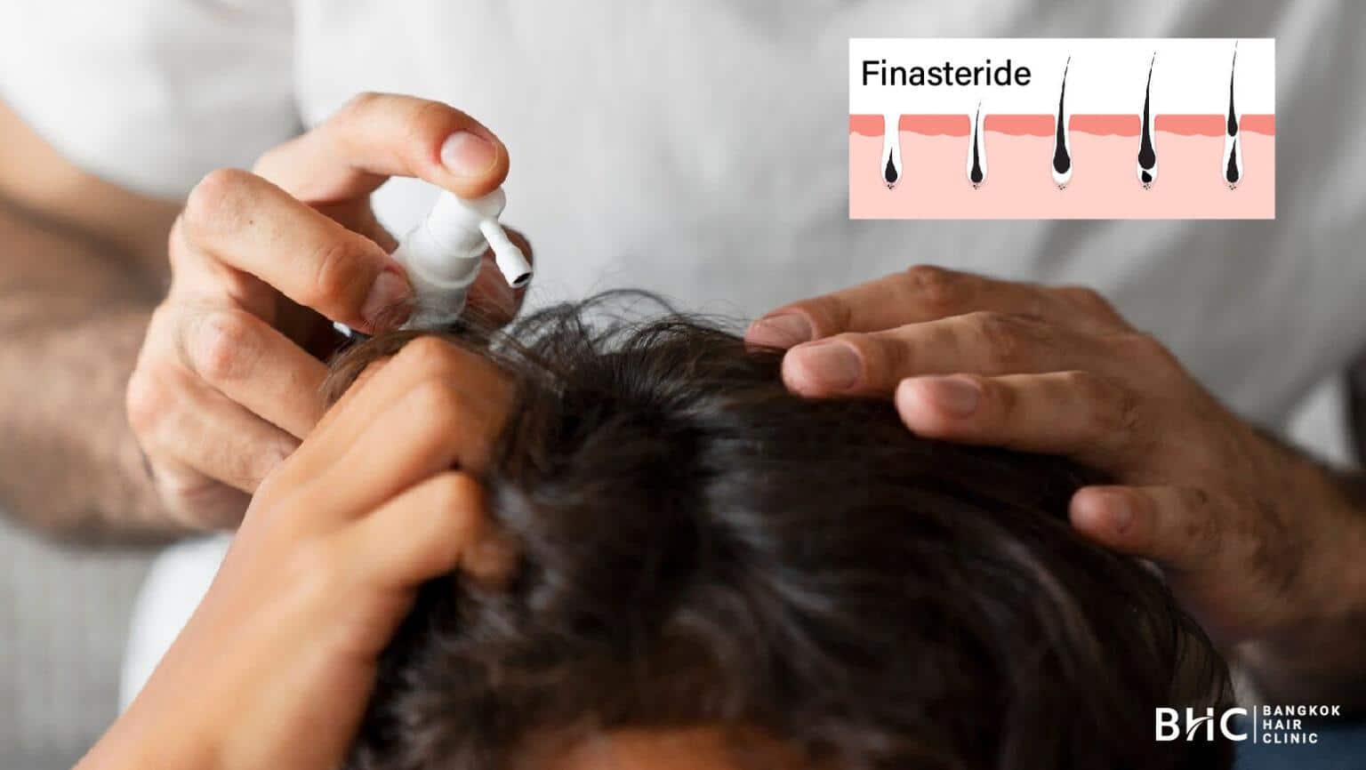 Tackling Finasteride Side Effects Effectively