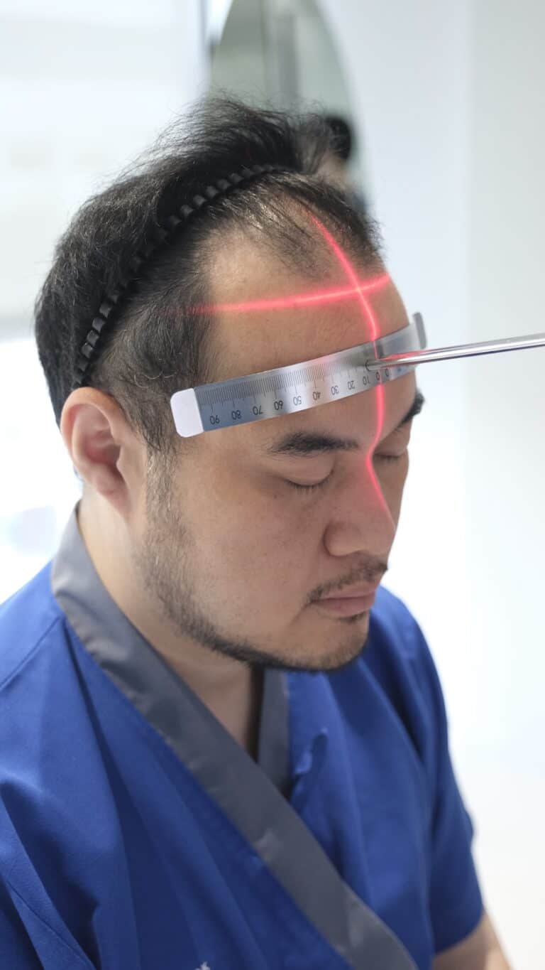 Long Hair DHI Transplant in Bangkok | Bangkok Hair Clinic